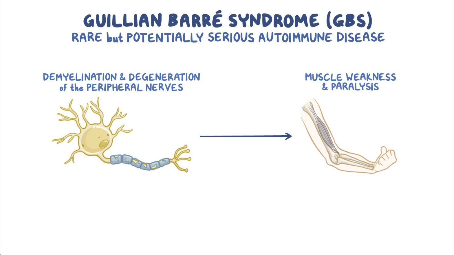 क्या है Guillain-Barre Syndrome? जिसकी वजह से पेरू में लगाई गई है हेल्थ ...